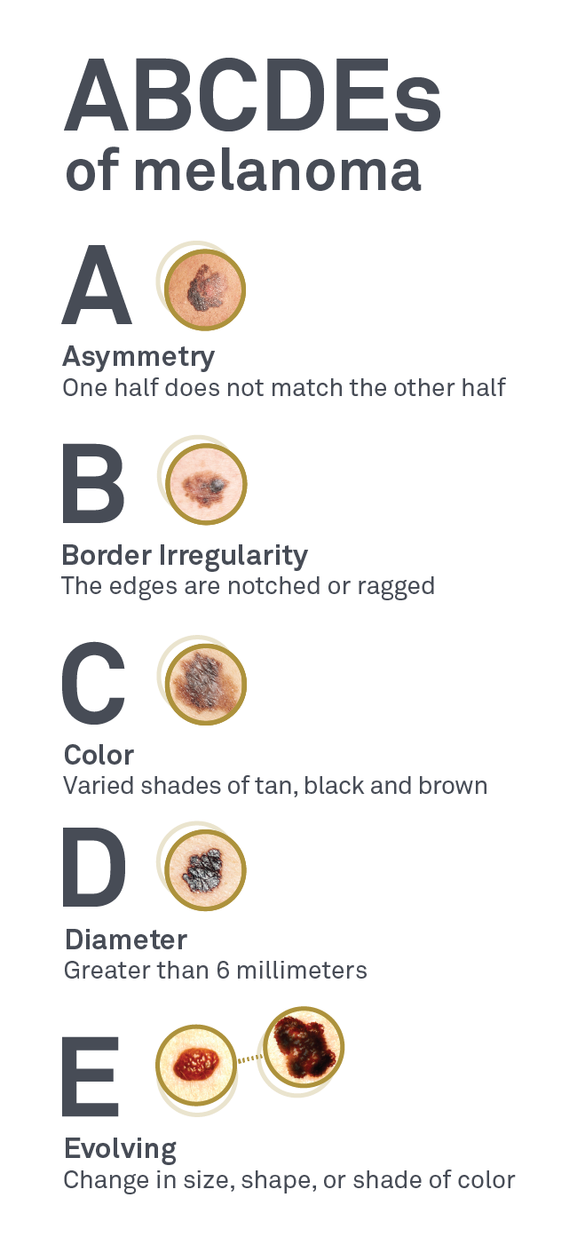 Figure. What to Look for in a Mole: The ABCDEs 10,11